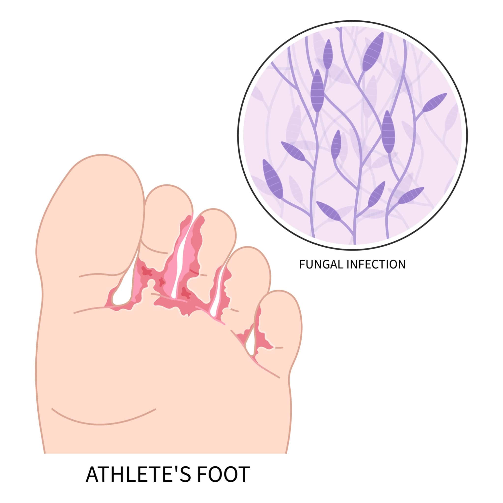 Urgent Care for Ringworm, Athlete's Foot and Fungal Infections | NextCare