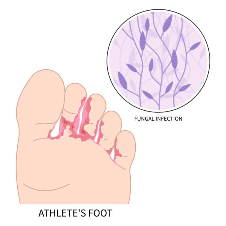 Urgent Care for Ringworm, Athlete's Foot and Fungal Infections | NextCare